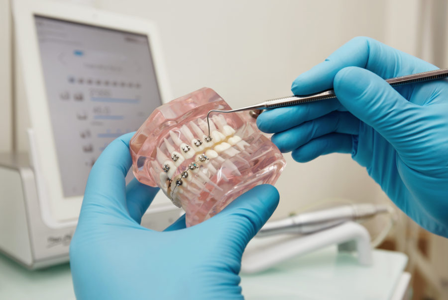 Todo sobre retenedores dentales - Clinica Dental Alba